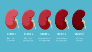 The 5 Stages of Kidney Disease and What They Mean for Life Expectancy ...