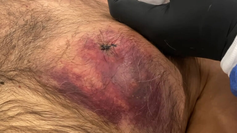 Pacemaker Surgery Recovery in the Elderly - What to Expect and How to ...